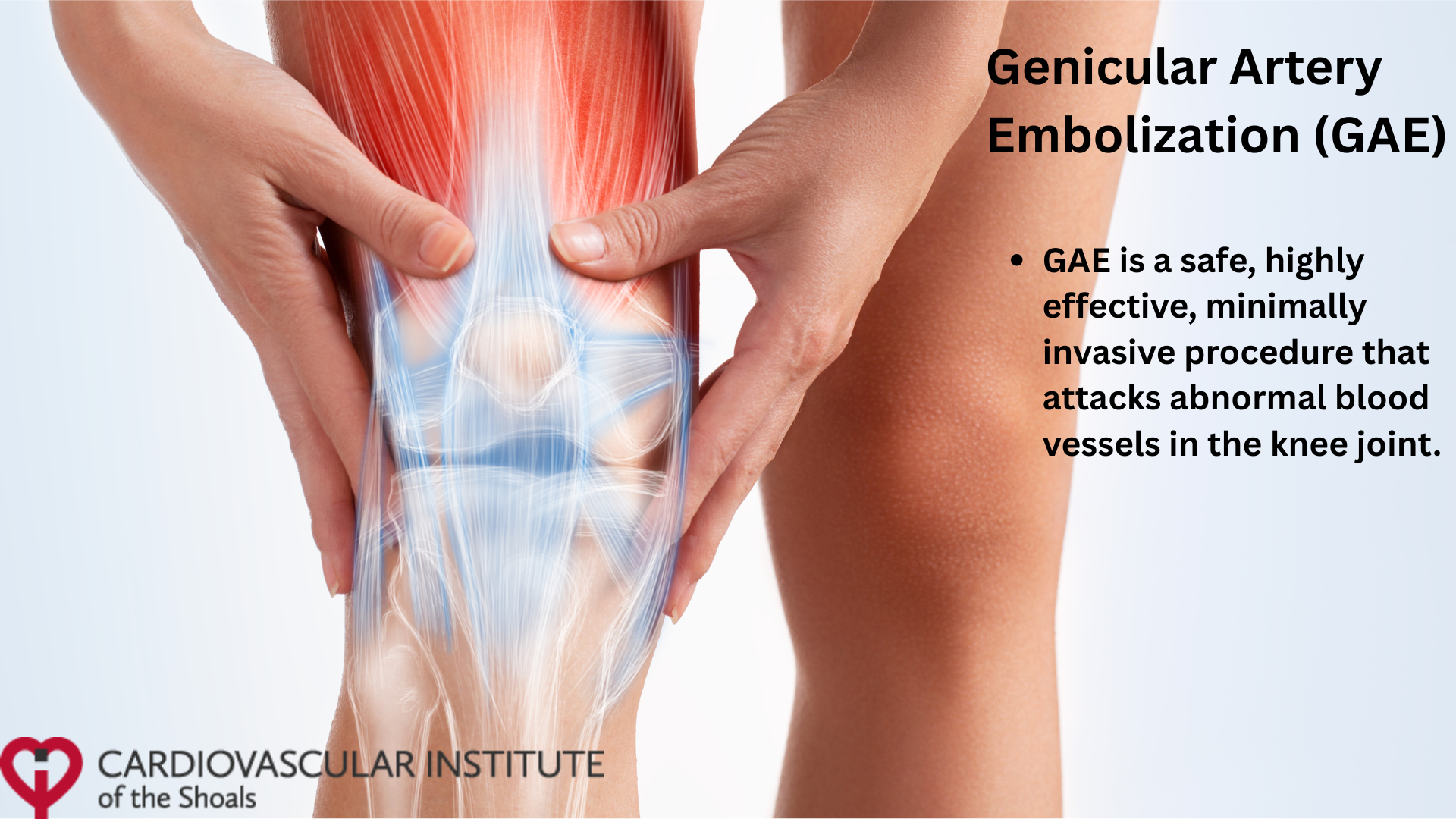 Genicular Artery Embolization (GAE) - Northwest Alabama Leg Pain ...